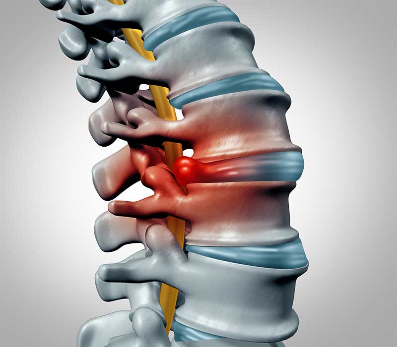Cervical Spine Infection Treatment In Tamilnadu